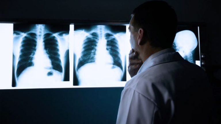 Angola continua a registar aumento de casos de tuberculose. em 2024 ...